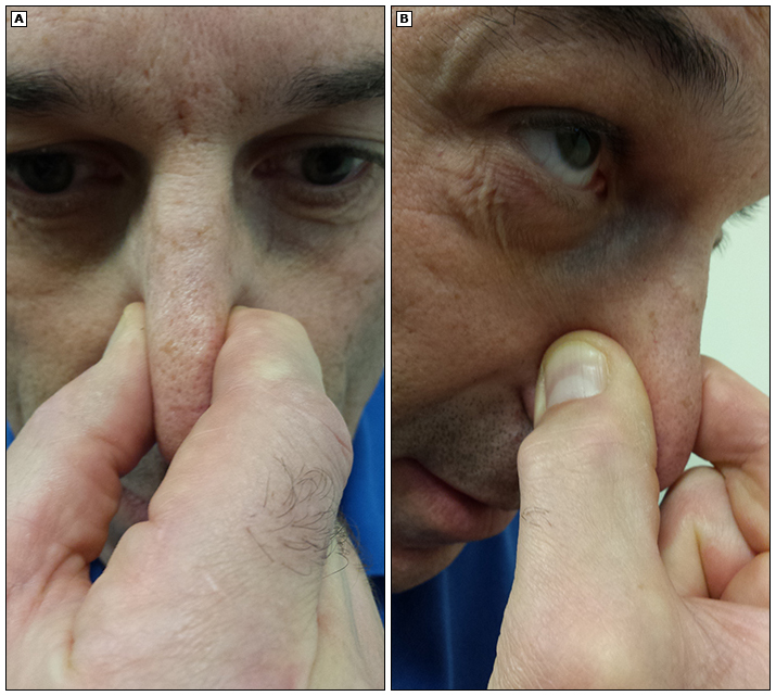Epistaxis- May 2021 | Internet Book of Emergency Medicine