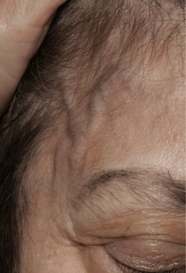 Giant Cell Arteritis | Internet Book of Emergency Medicine